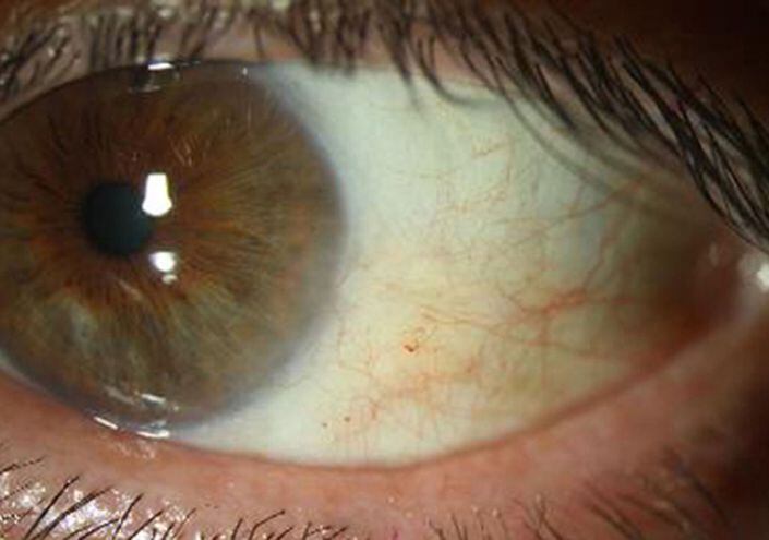 Superficie del ojo con lesiones - Salud - ABC Color