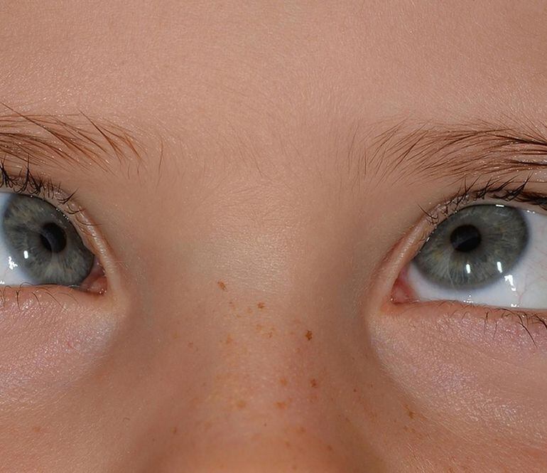 Ojos desviados - Salud - ABC Color