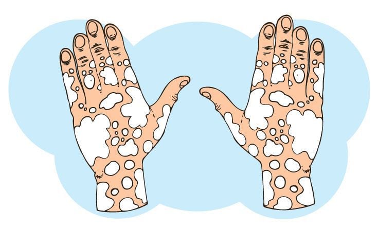 La lepra - Escolar - ABC Color