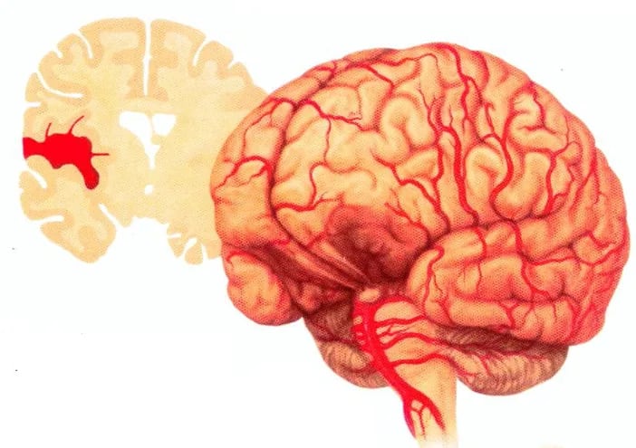 Isquemia cerebral - Salud - ABC Color